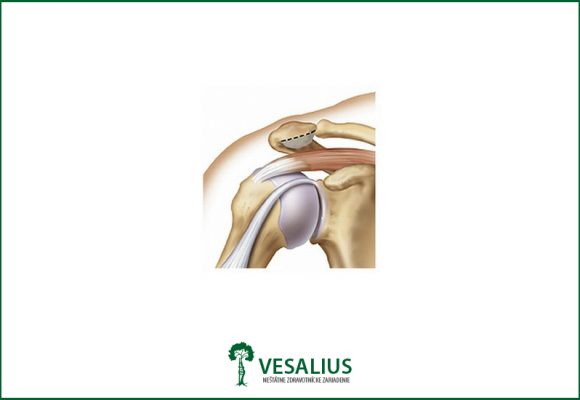 Subakromiálna dekompresia | VESALIUS s.r.o. - ortopedická ambulancia a JZS