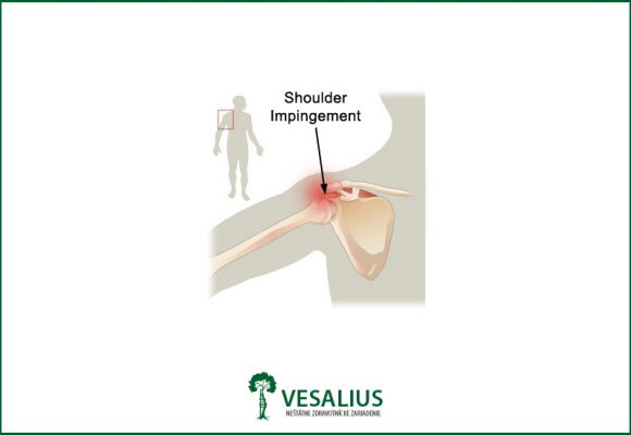 Subakromiálna dekompresia | VESALIUS s.r.o. - ortopedická ambulancia a JZS
