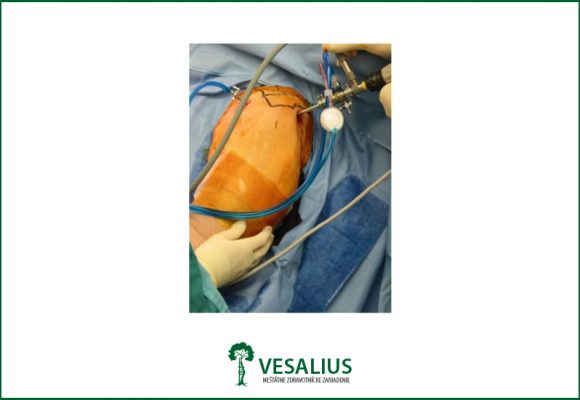 Artroskopia ramena | VESALIUS s.r.o. - ortopedická ambulancia a JZS